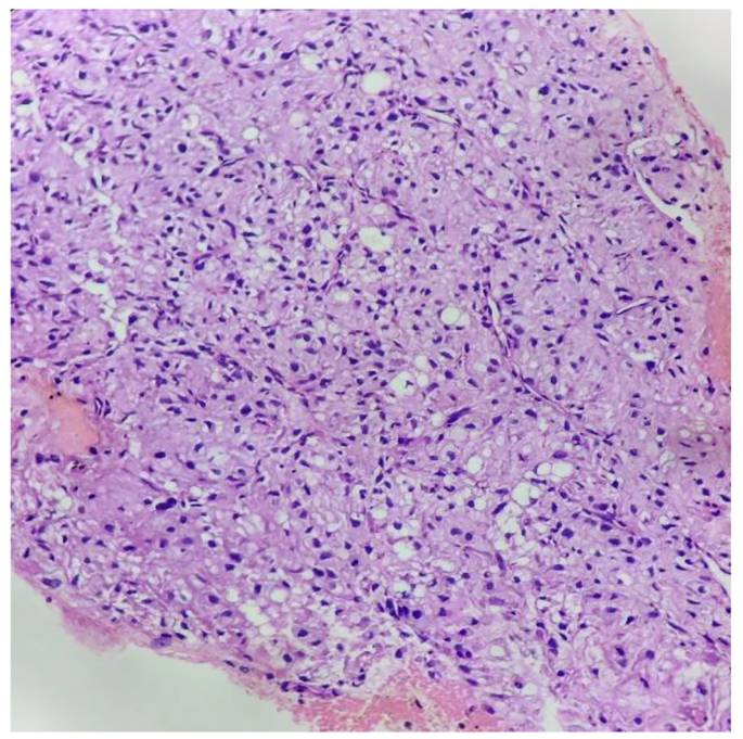 Liposarcoma of Maxilla- A Rare Case Report | Indian Journal of ...