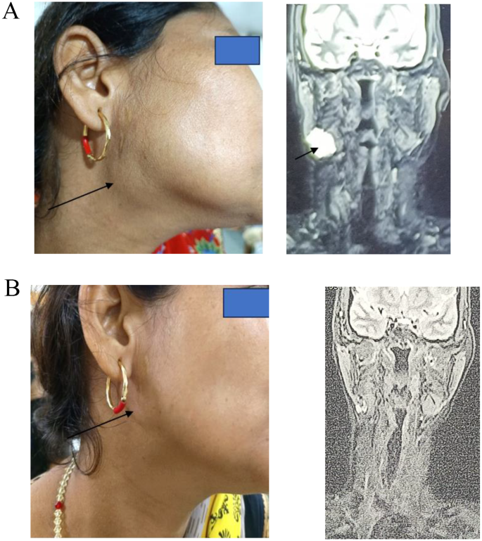 Exploring Bleomycin vs. Setrol Injections in Adults | Indian Journal of ...