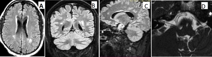Head Shaking Nystagmus & Vertigo – Multiple Sclerosis or Vestibular ...