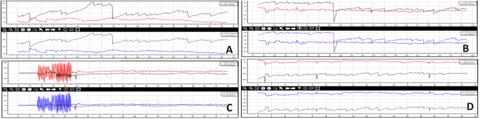 Orgasmic Vertigo in a Peri-Menopausal Female | Indian Journal of ...