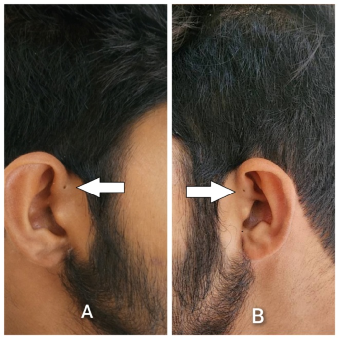 “A Unique Case of Branchio-Oto-Renal Spectrum Disorder” | Indian ...
