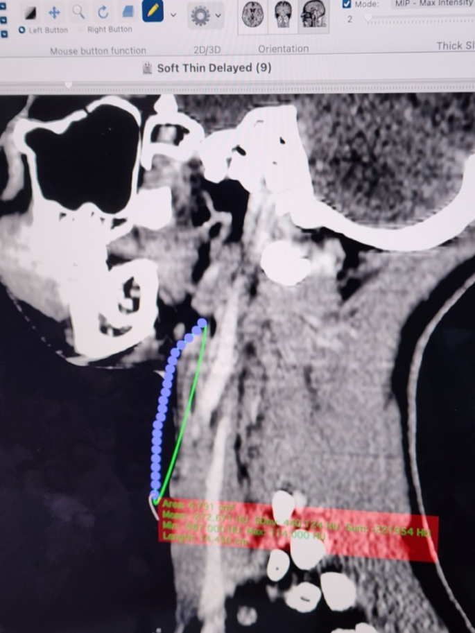 “A Unique Case of Branchio-Oto-Renal Spectrum Disorder” | Indian ...