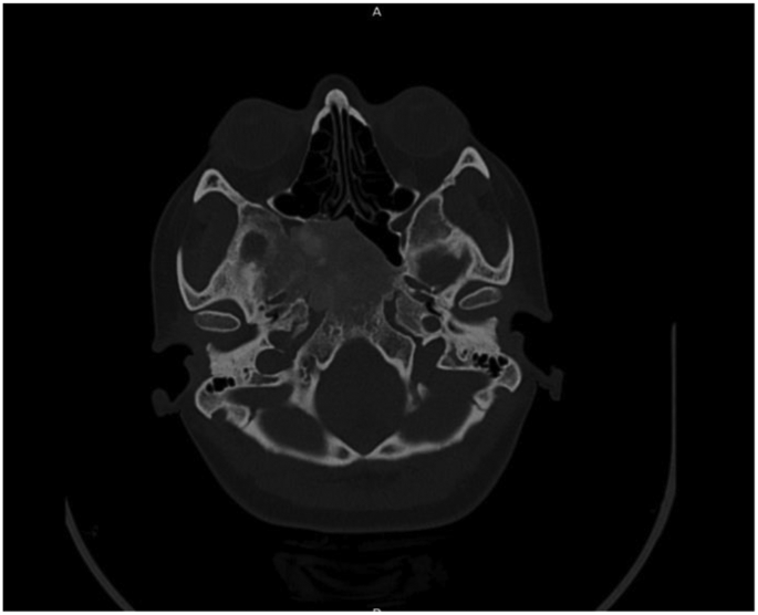 Fibrous Dysplasia of Sphenoid: A Case Report | Indian Journal of ...