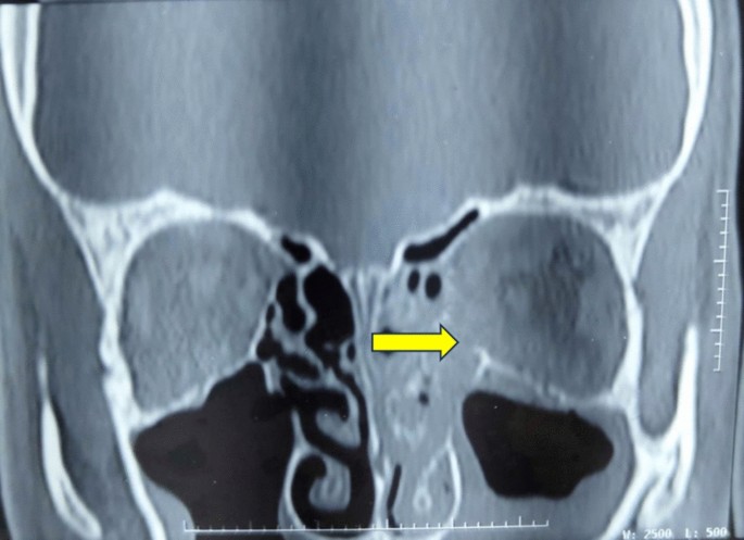A Race Against Time: Rapidly Progressive Methicillin Resistant ...