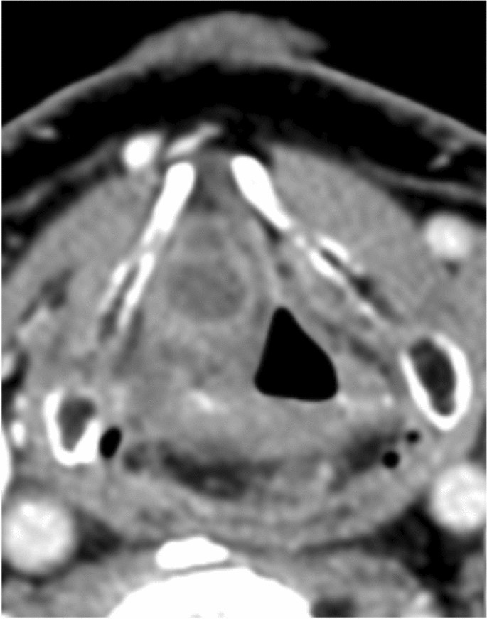 Laryngeal Abscess: A 34-Year Review | Indian Journal of Otolaryngology ...