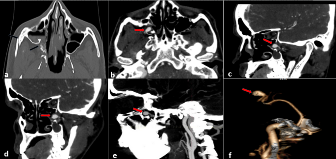 Sphenopalatine Artery Pseudoaneurysm Managed with Endovascular ...