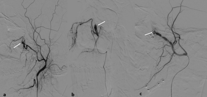 Sphenopalatine Artery Pseudoaneurysm Managed with Endovascular ...