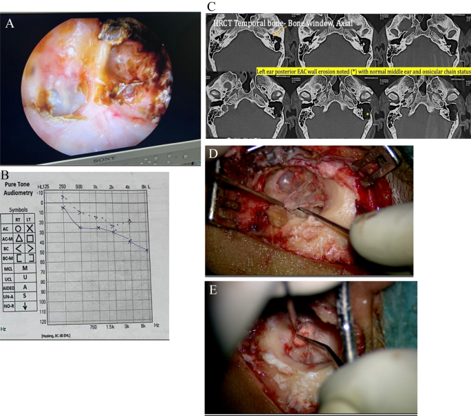 Diagnostic and Surgical Challenges in External Auditory Canal ...