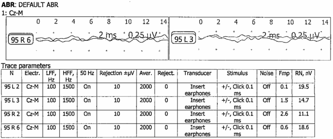 Congenital Arrhinia with Profound Hearing Loss and Complete Cleft ...