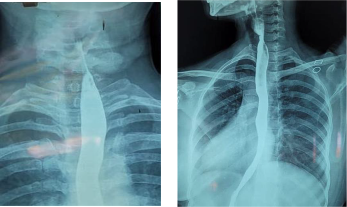 A Study on Association Between Anaemia and Cricoid Webs in Patients ...