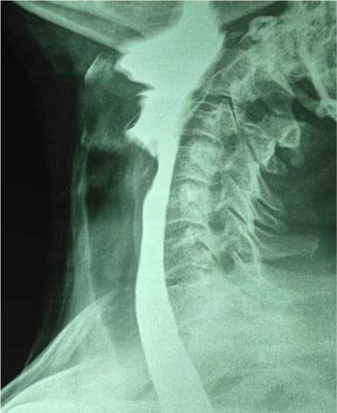 A Study on Association Between Anaemia and Cricoid Webs in Patients ...