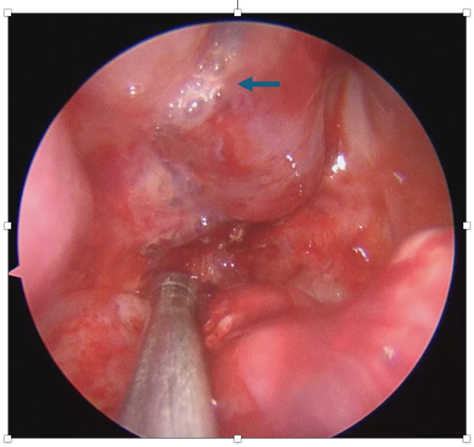 Choanal Atresia in Adult- Endoscopic Surgery and Reconstruction - A ...