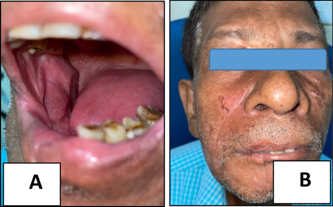 ‘Nasolabial Flap’: A Versatile Solution for Oromandibular Defect ...