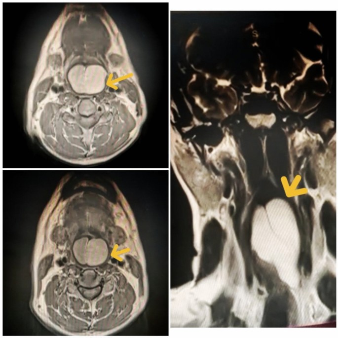 Excision of Bilobed Supraglottic Lipoma via Transoral Robotic Surgery ...