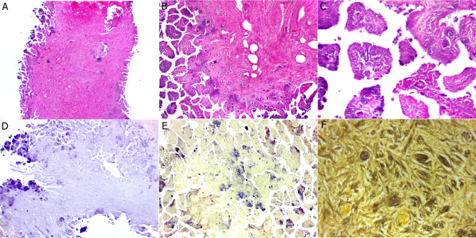Intraoral Ulceration in a Paediatric Patient Mimicking Bednar’s Aphthae ...