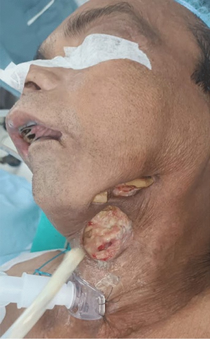 Management of an Osteoradionecrosis of Mandible with Pharyngeal Fistula ...