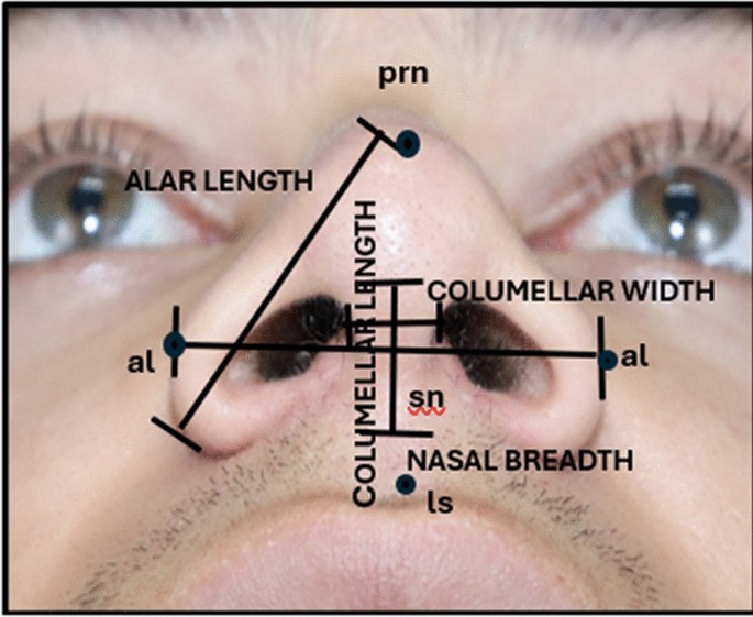 Anthropometric Analysis of Base of the Nose in an Indian Population: A ...