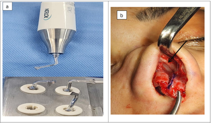 A Comparative Assessment of Piezo-Assisted Versus Conventional ...