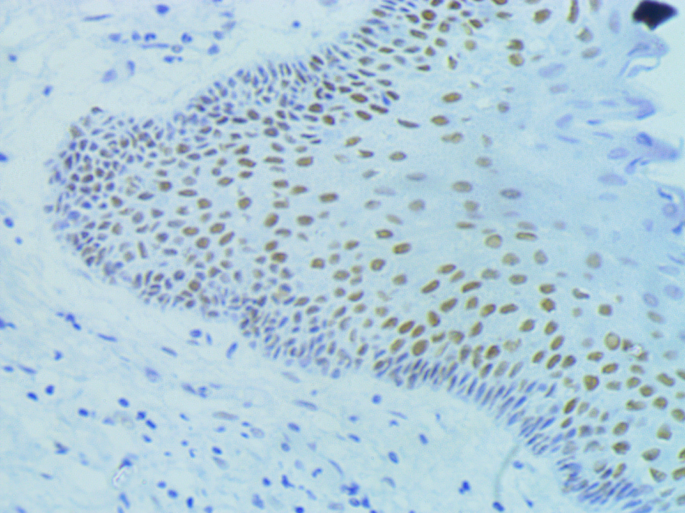 Profiling Expression of Proliferation Proteins in Cases of Odontogenic ...