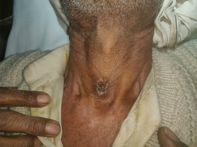 Case Report—Case of Scrofuloderma Presenting as Infected Non-healing ...
