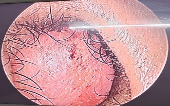 Nasal Septal Fibroma of Cartilaginous Origin: An Infrequent Occurrence ...