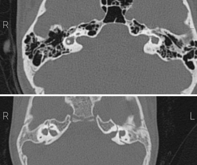 Correlation of CT Scan and Audiogram Findings in Ears with Lateral ...