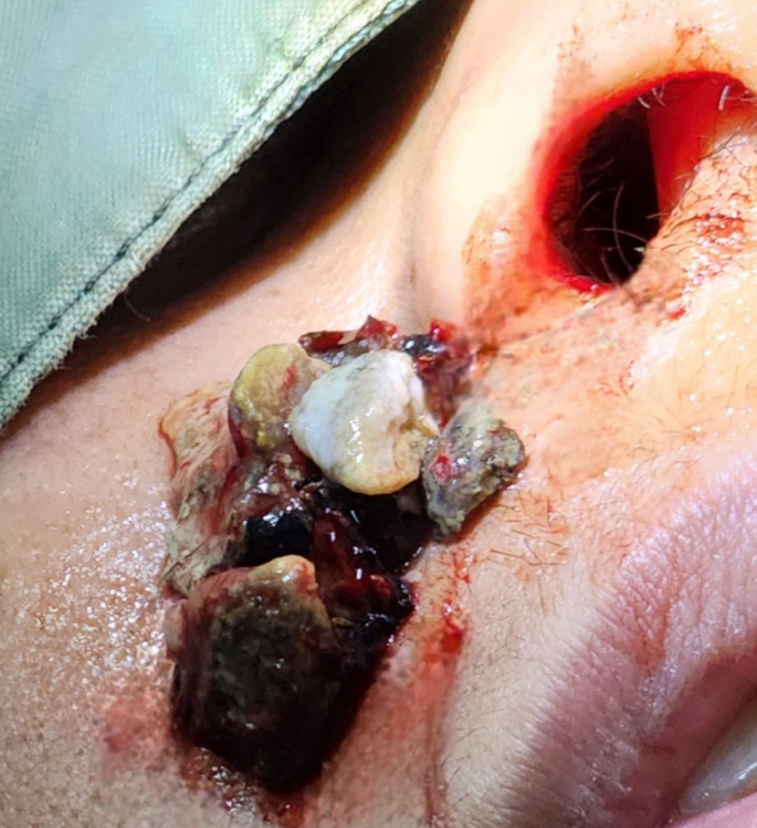 Ectopic Tooth Eruption from Inferior Turbinate in Nose with Rhinolith ...