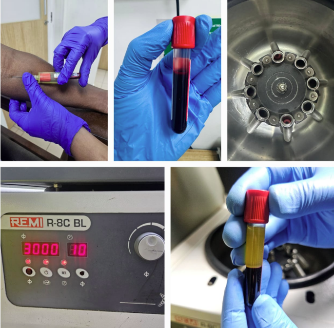 Platelet Rich Fibrin(PRF) and Platelet Rich Plasma (PRP) in Endoscopic ...