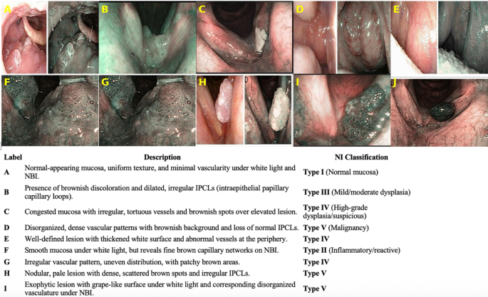 A Comparative Study of NBI and Contact Endoscopy for Early Assessment of Malignancy in Head and ...