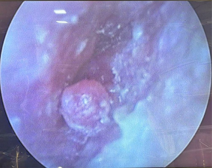 Early Surgical Intervention with Collagen-Assisted Healing in Malignant ...