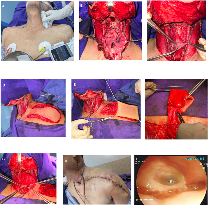Surgical Experience in Applying the Supraclavicular Artery Island Flap ...