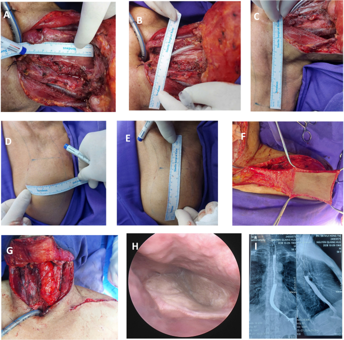 Surgical Experience in Applying the Supraclavicular Artery Island Flap ...