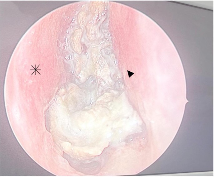 From Foul Discharge To Nasal Destruction: A Case of Neglected Rhinolith ...