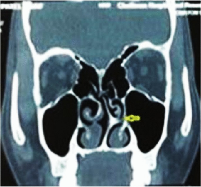 To Evaluate Impact of Intranasal Contact Points on Refractory Headaches ...