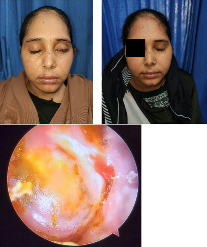 A Rare Case Report of Primary Angiosarcoma of Temporal Bone | Indian ...