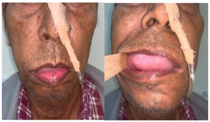 Minimally Invasive, Targeted Biopsy of Advanced Base of Tongue Tumours ...
