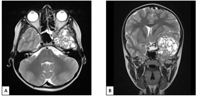 Ewing Sarcoma of the Sphenoid Bone: Navigating a Rare Anatomical ...