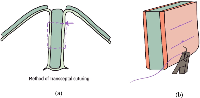 A Randomized Comparative Study of Physiological Parameters of the Nose ...