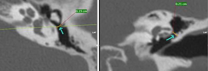 Aditus Ad Antrum Diameter in Chronic Otitis Media Ears and Healthy Ears ...