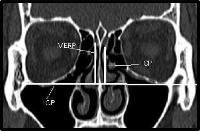 CT-Based Evaluation of Olfactory Fossa Variations and Their Surgical ...