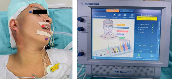 A Prospective Study of Intra Operative Nerve Monitoring of Facial Nerve ...