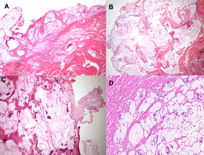 Peritoneal metastasis histological grade independently predicts outcome ...