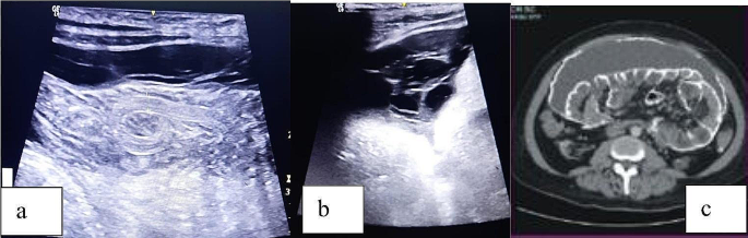 Sclerosing Peritonitis Possibly Due to Ascaris Infestation | Indian ...