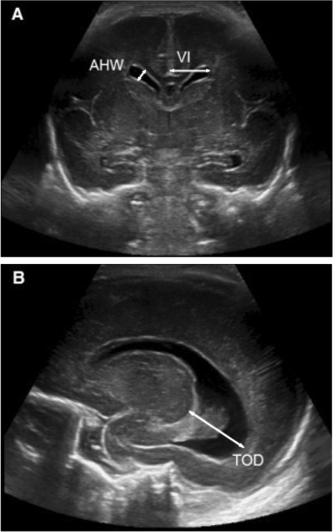 Nomograms and Reference Ranges for Intra-Cranial Ventricular Dimensions ...