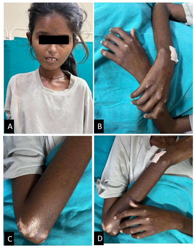 The Salt & Pepper Enigma: A Cutaneous Cipher to Seronegative Systemic ...