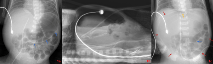 A Preterm Neonate with Acute Abdomen: How Much Does the Radiograph ...