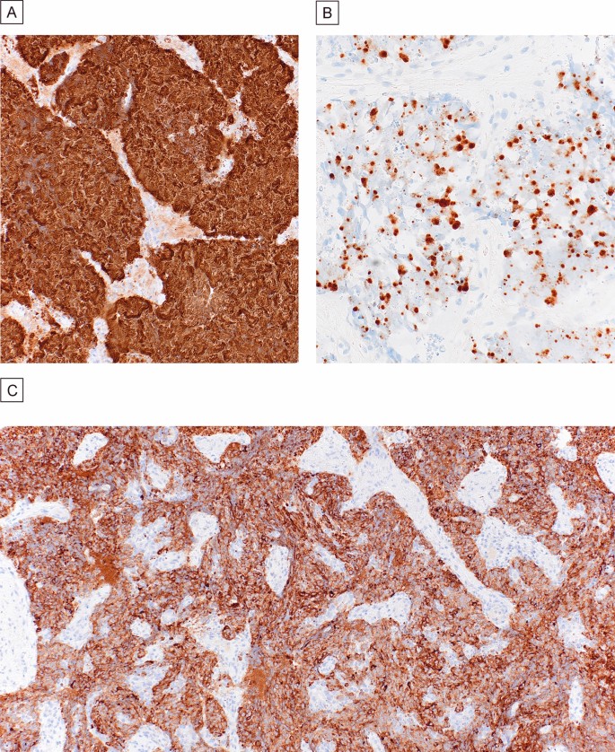 Oropharyngeal Mixed Neuroendocrine-Nonneuroendocrine Neoplasm (MiNEN ...