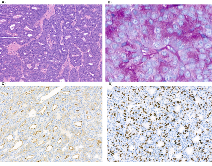 A Case of Acinic Cell Carcinoma with SYN2::PPARG Fusion | Head and Neck ...