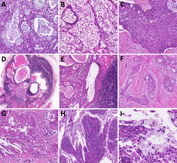 Association Between the Histological Subtypes, Anatomical Locations ...