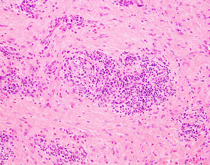 Eosinophilic Angiocentric Fibrosis: An Uncommon Entity in the Spectrum ...